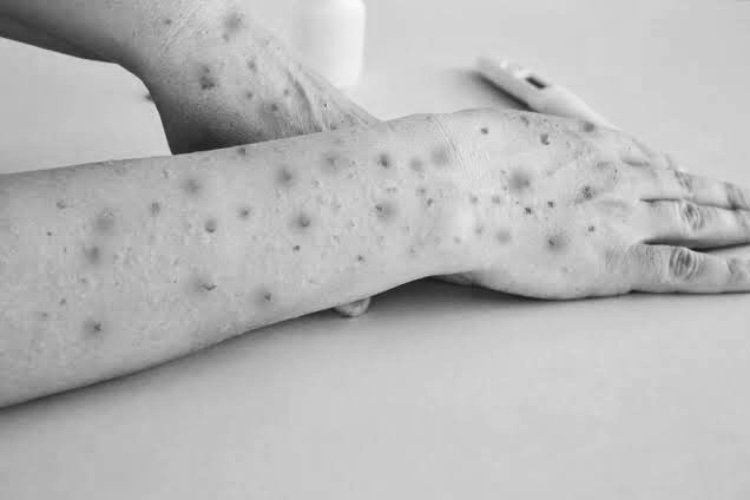 Prevention and Precautions against for M Pox - Welthi | Healthcare Tips ...